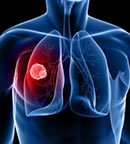 Lorlatinib in Second- or Third-Line Treatment of ALK-Positive ...
