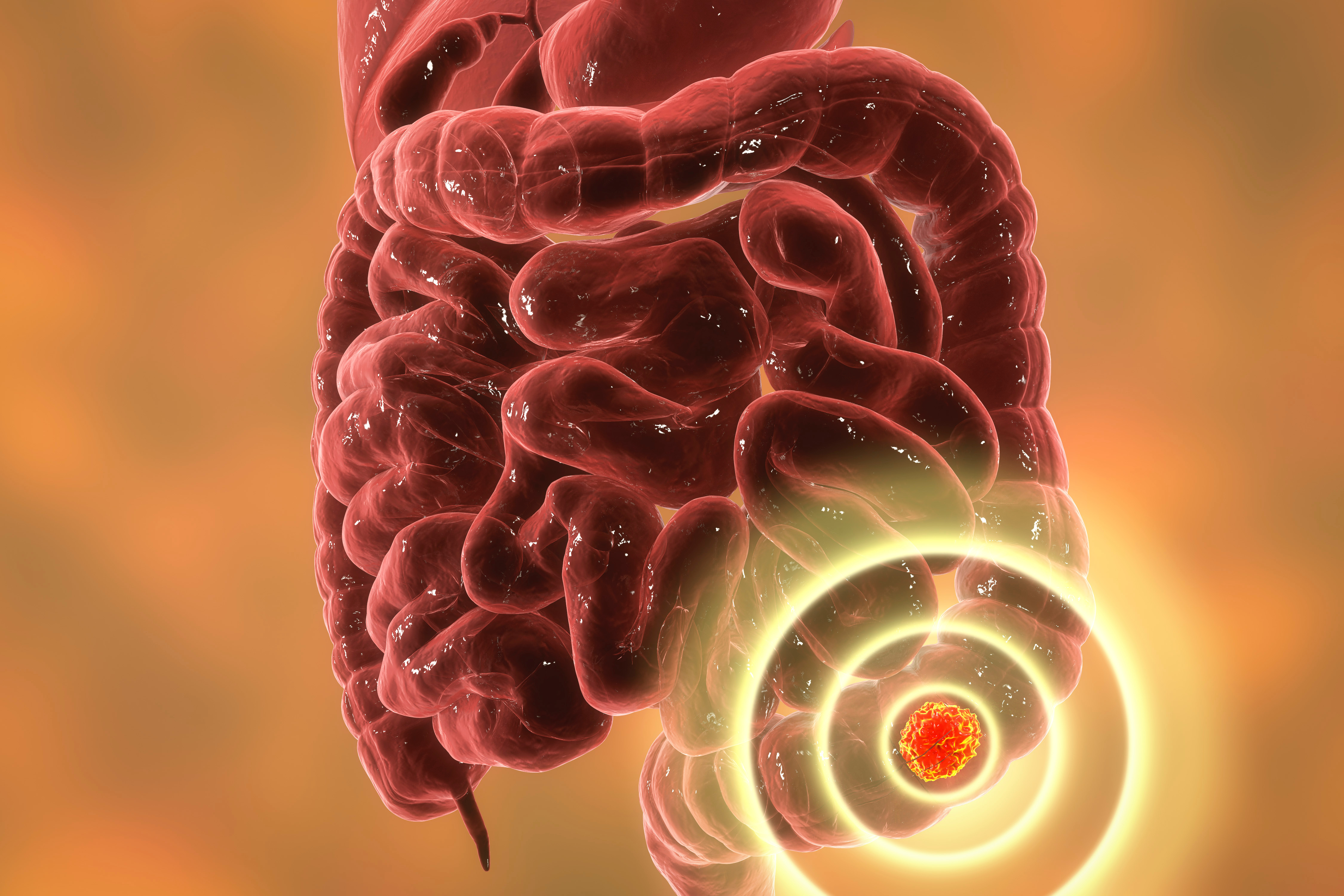 Pretargeted Dual Isotope Radionuclide Therapy in Colorectal Cancer ...