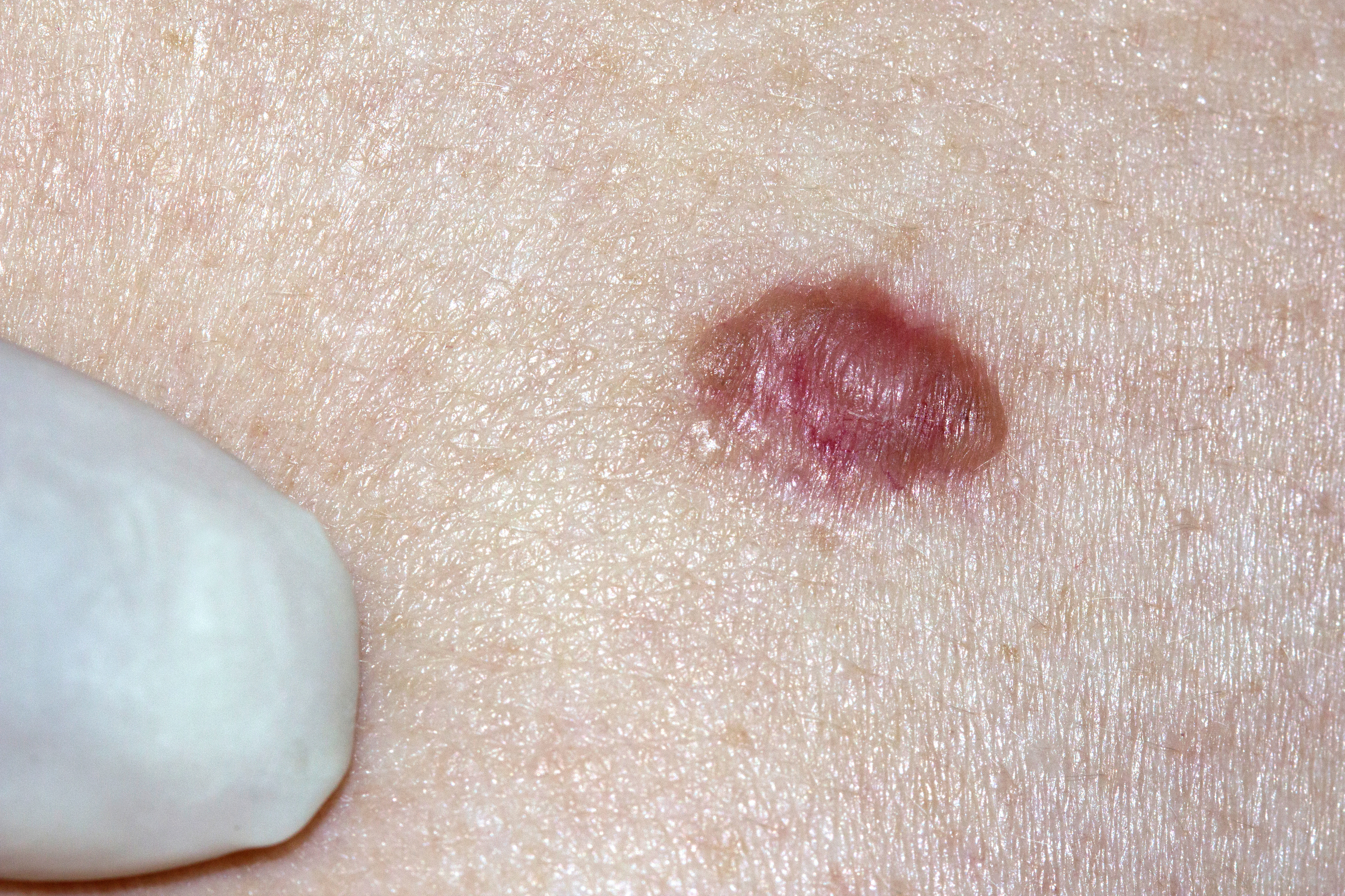 Novel Algorithm May Help to Identify Aggressive Basal Cell Carcinoma ...