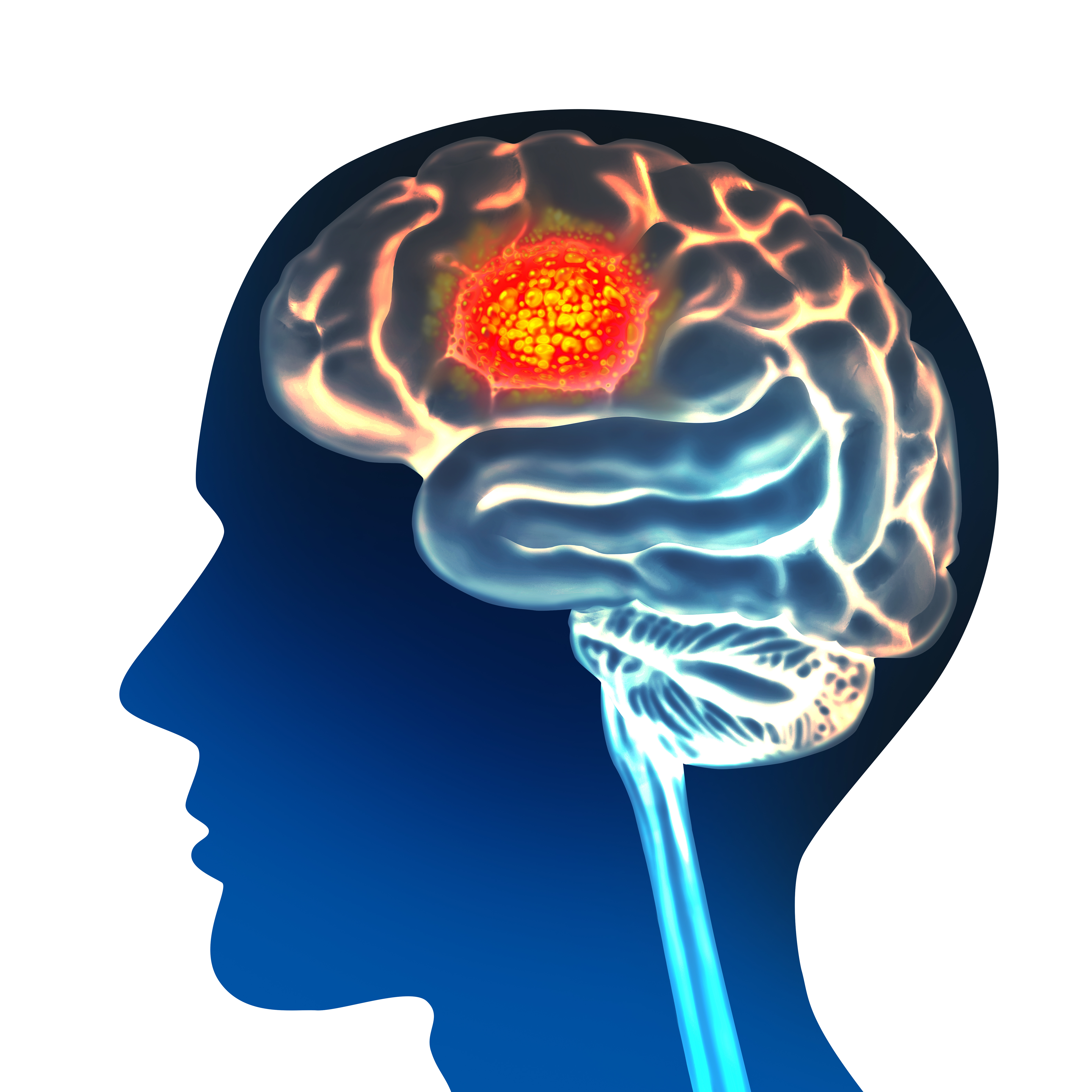 HER3-DXd in Patients With Active Brain Metastases From NSCLC and Breast ...
