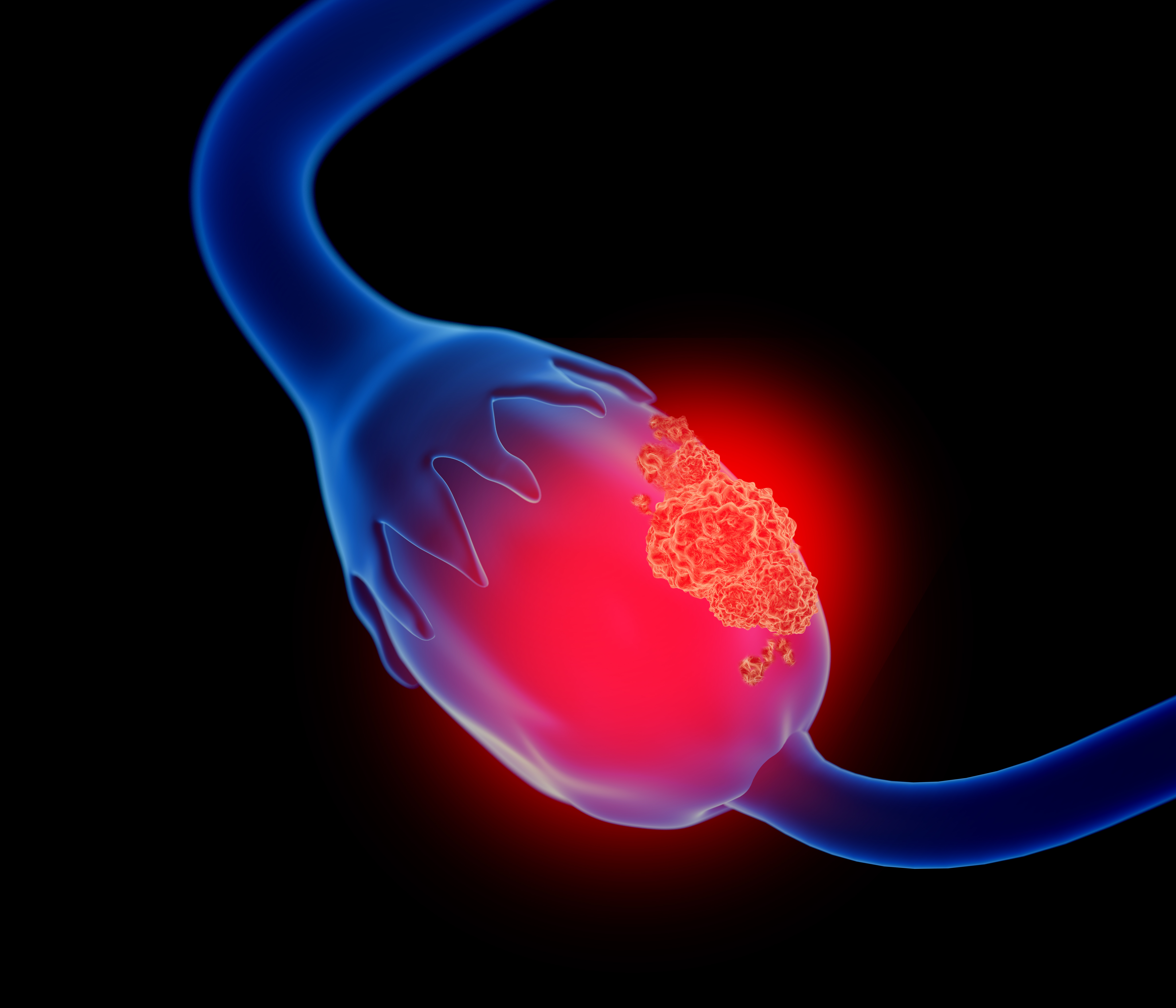 HIPEC in Platinum-Sensitive Recurrent Ovarian Cancer - The ASCO Post