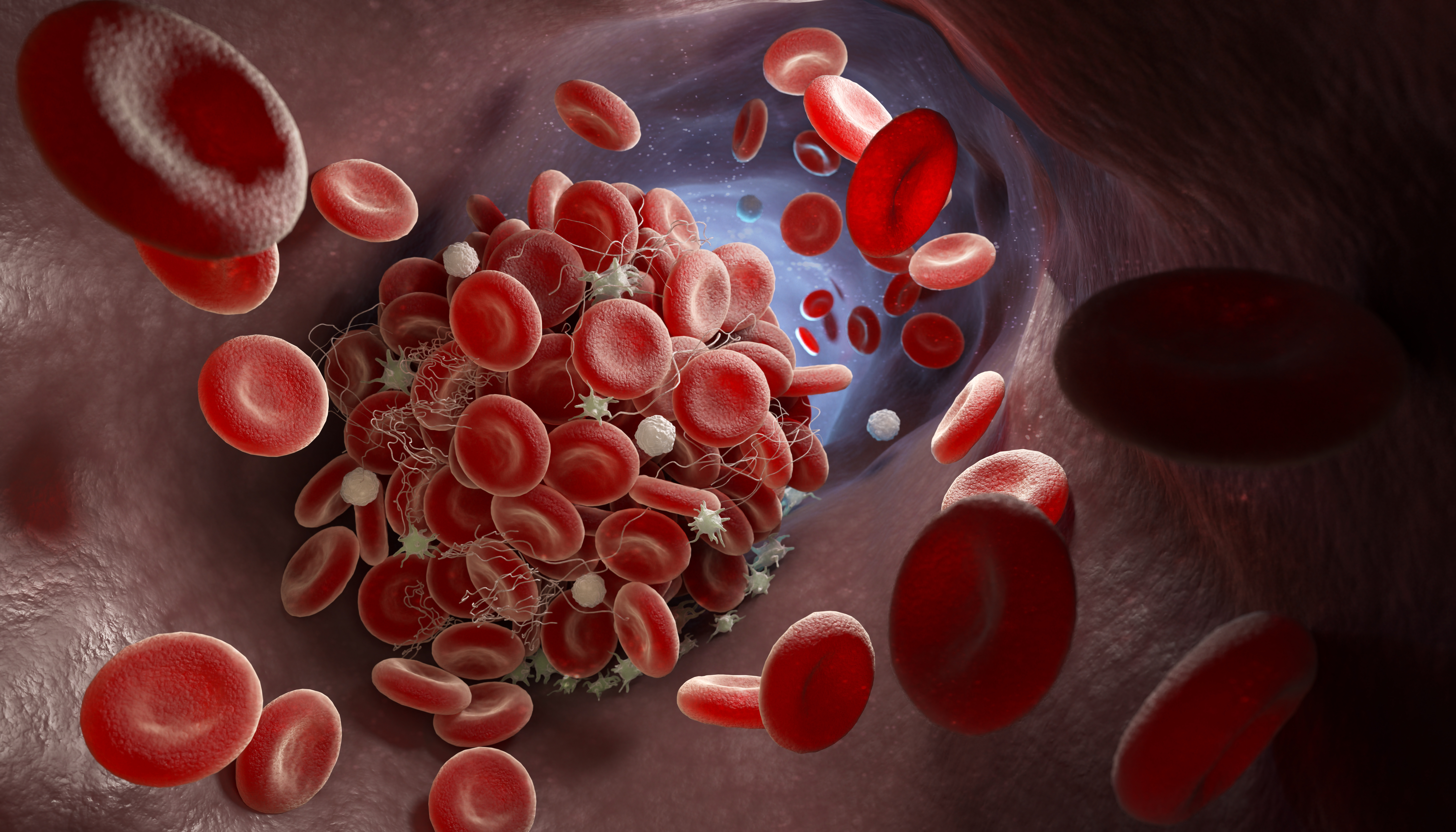 Liquid Biopsy May Predict Risk of Venous Thromboembolism in Patients ...