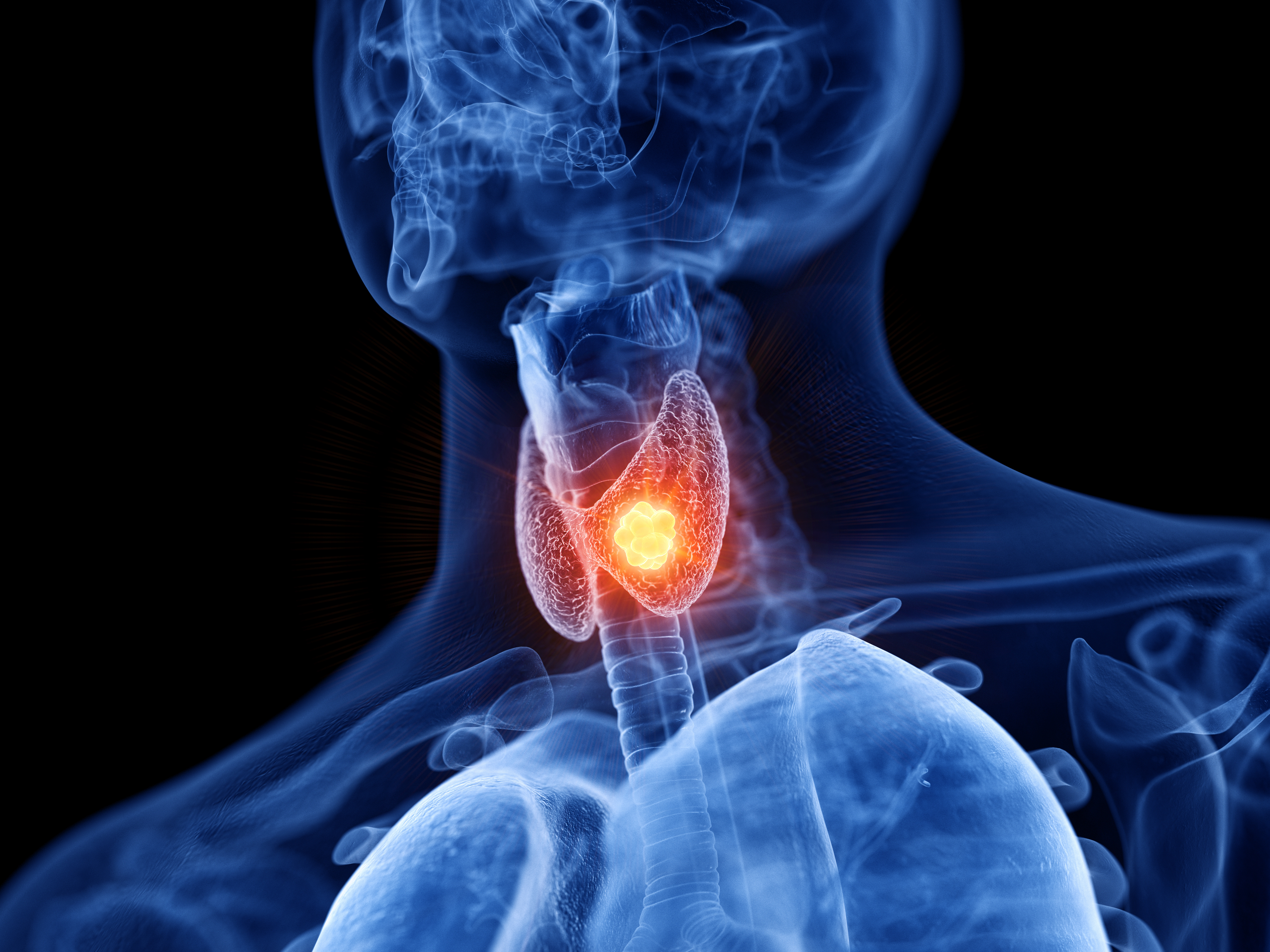 Immunotherapy Plus Targeted Therapy for Anaplastic Thyroid Carcinoma ...