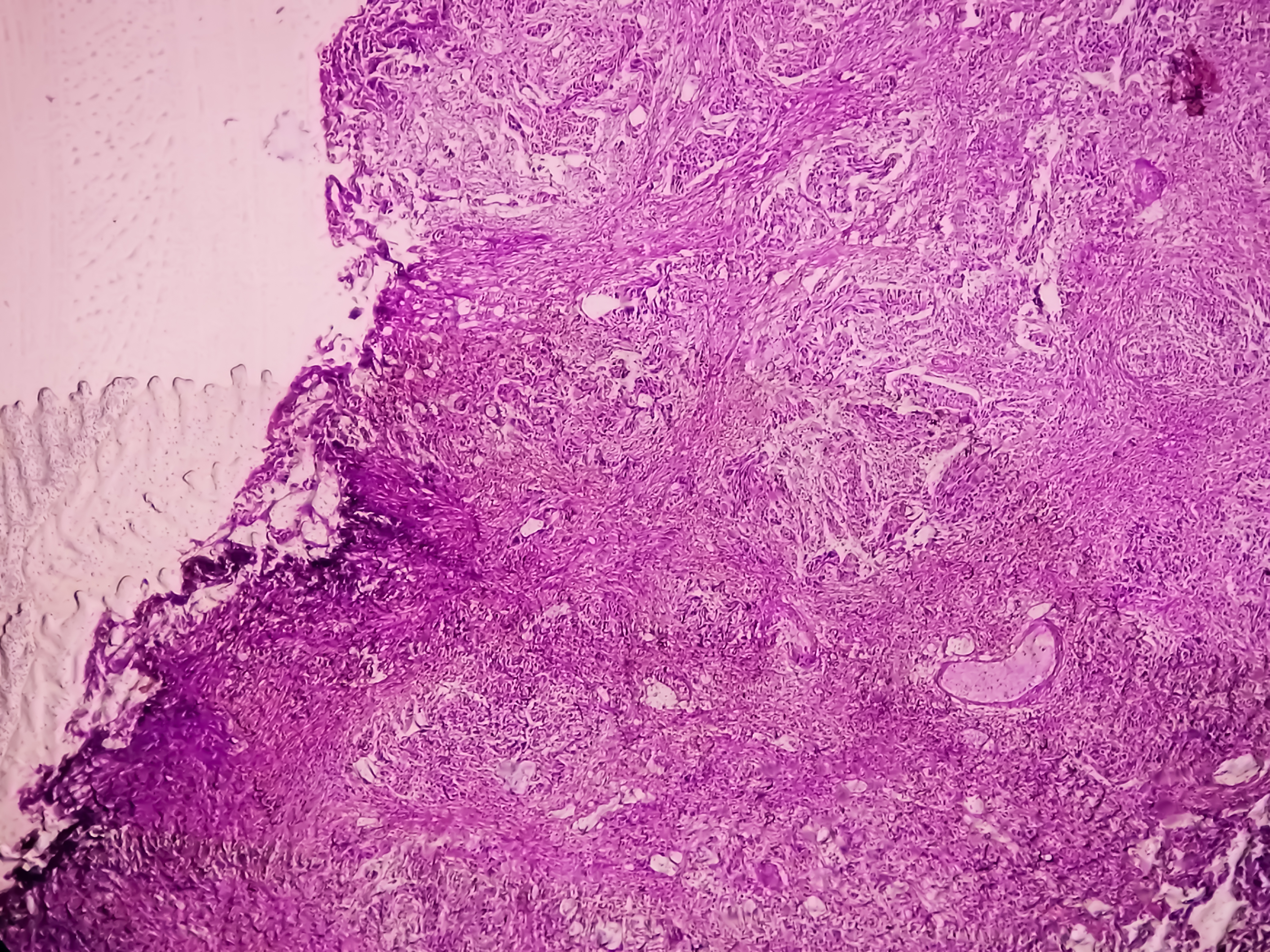 Treatment Advances, Predictive Biomarkers May Improve Urothelial ...