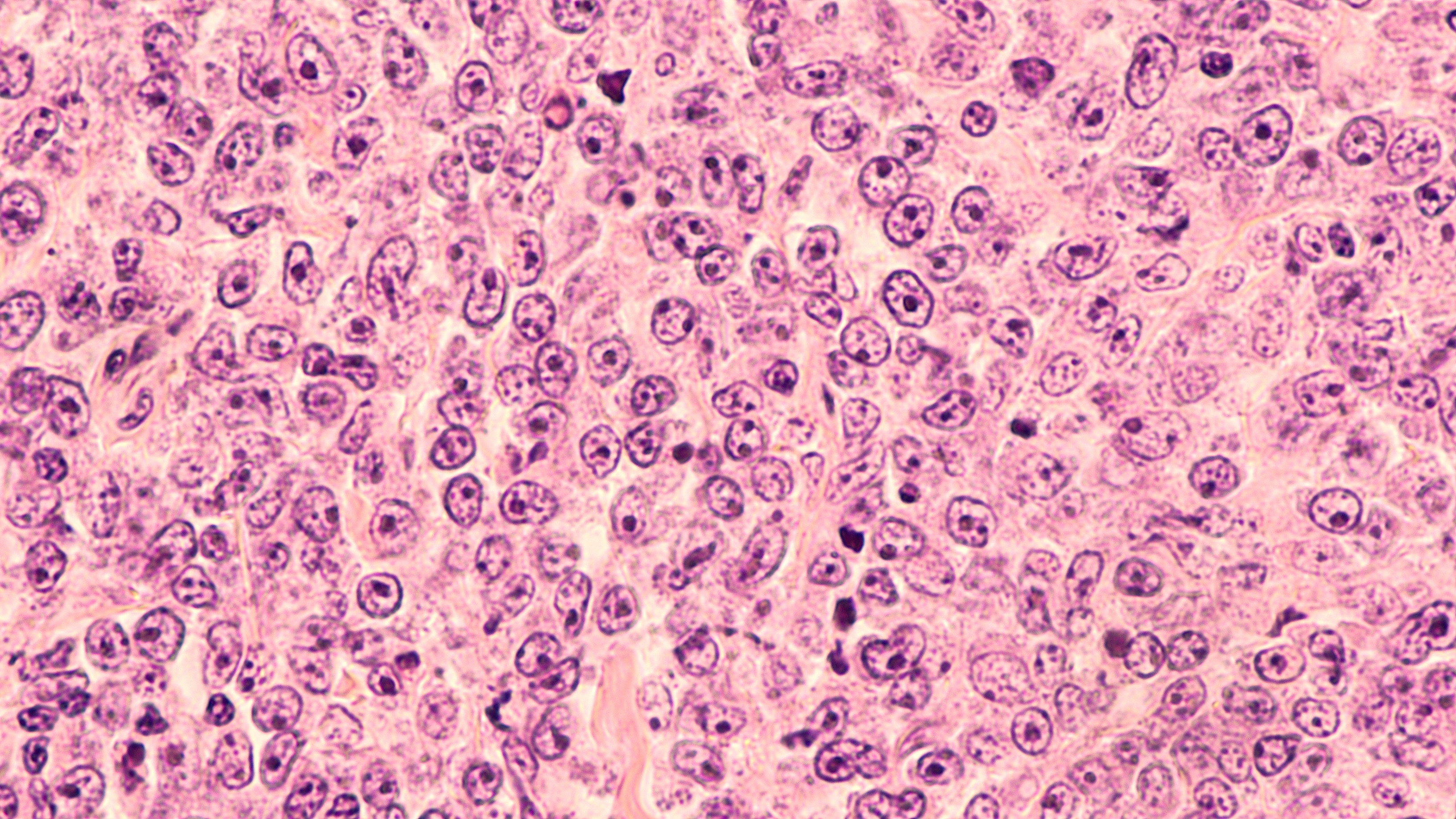 Lisocabtagene Maraleucel as Second-Line Therapy in Relapsed/Refractory ...