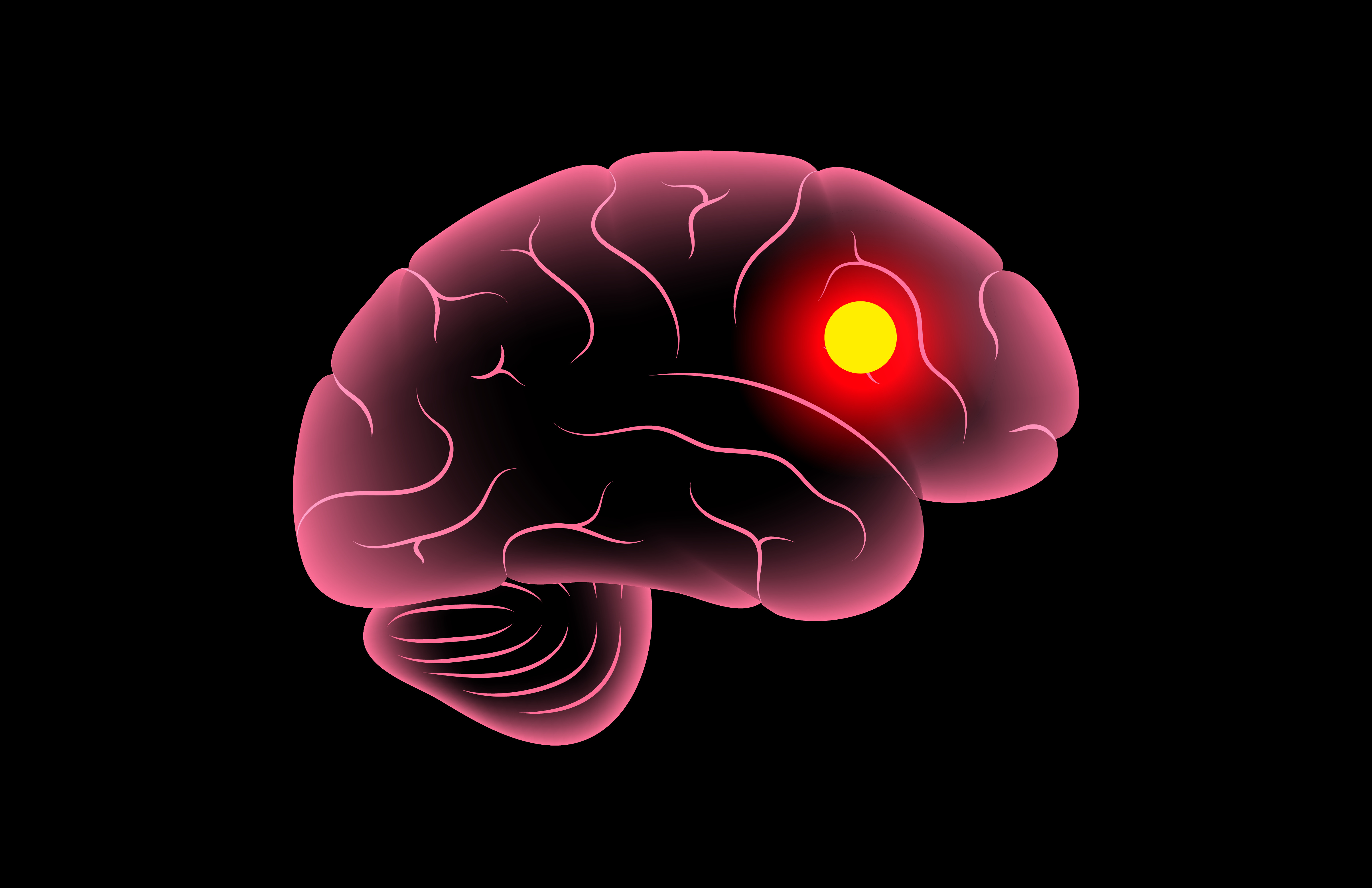 Glioblastoma Dual Immunotherapy Plus Radiotherapy in Newly Diagnosed ...