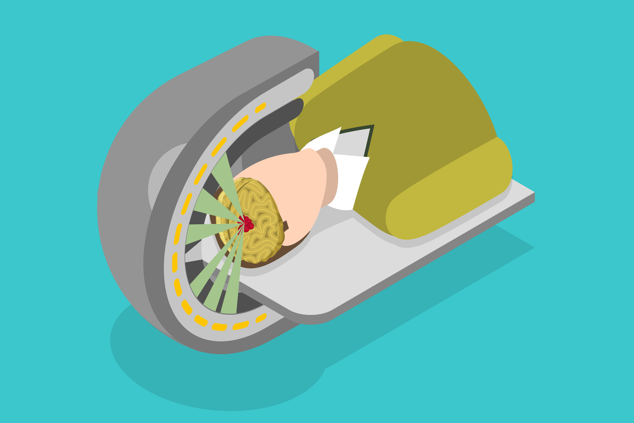 Phase II Trial Supports SRT as Alternative to WBRT in SCLC - The ASCO Post