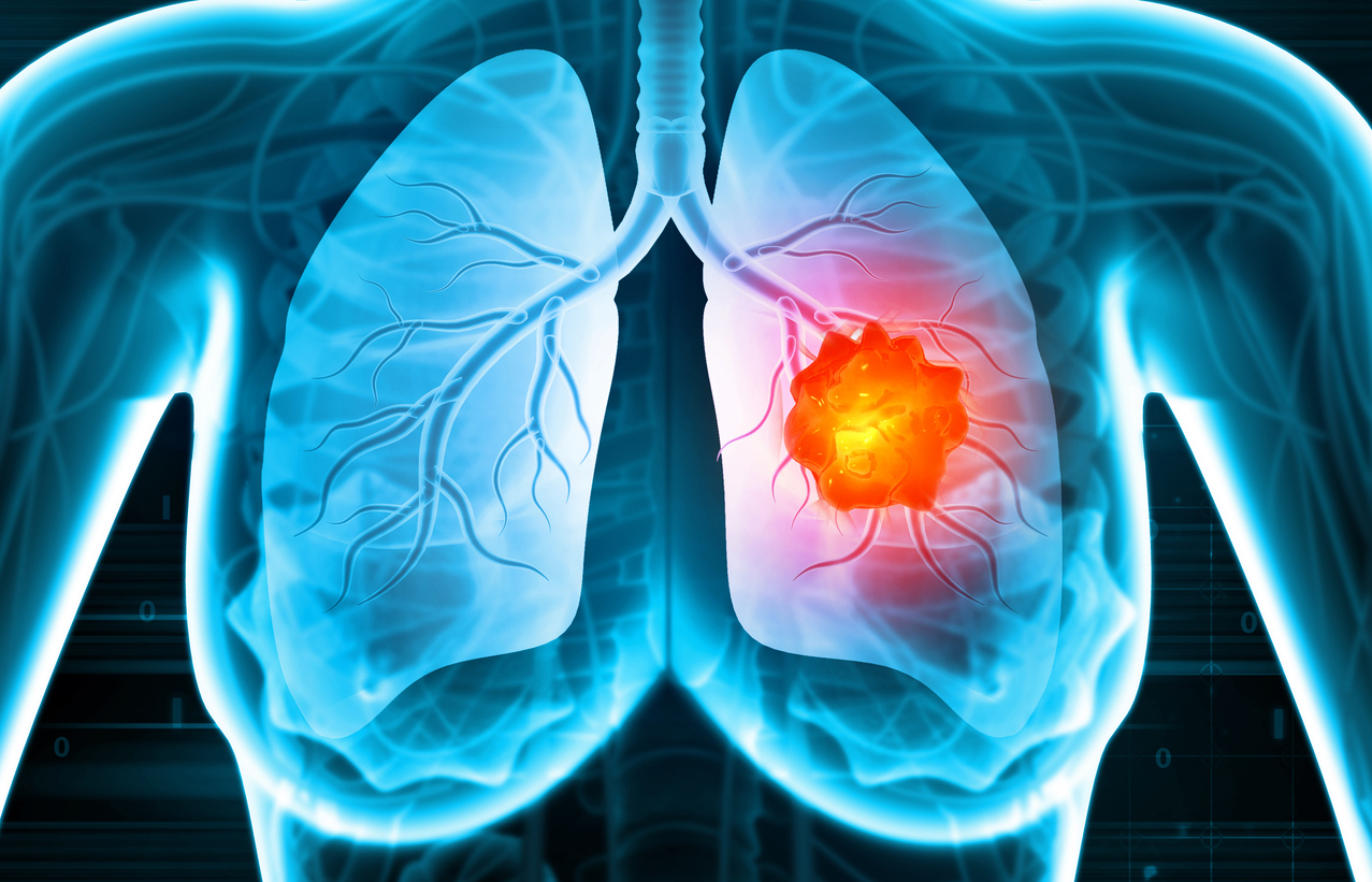 Adjuvant Chemoimmunotherapy for Resected Stage IB–IIIA NSCLC - The ASCO ...