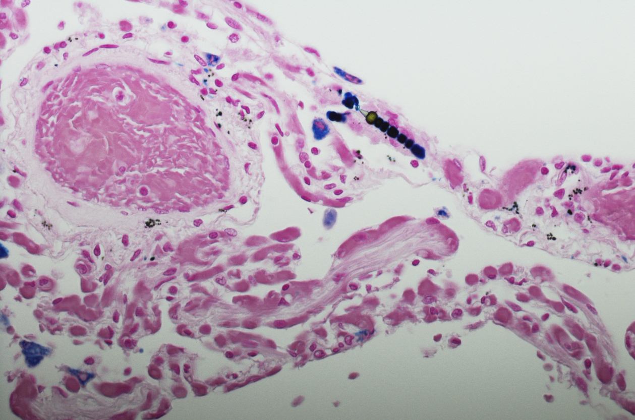 VT3989 Demonstrates Antitumor Activity and Tolerability in Refractory ...