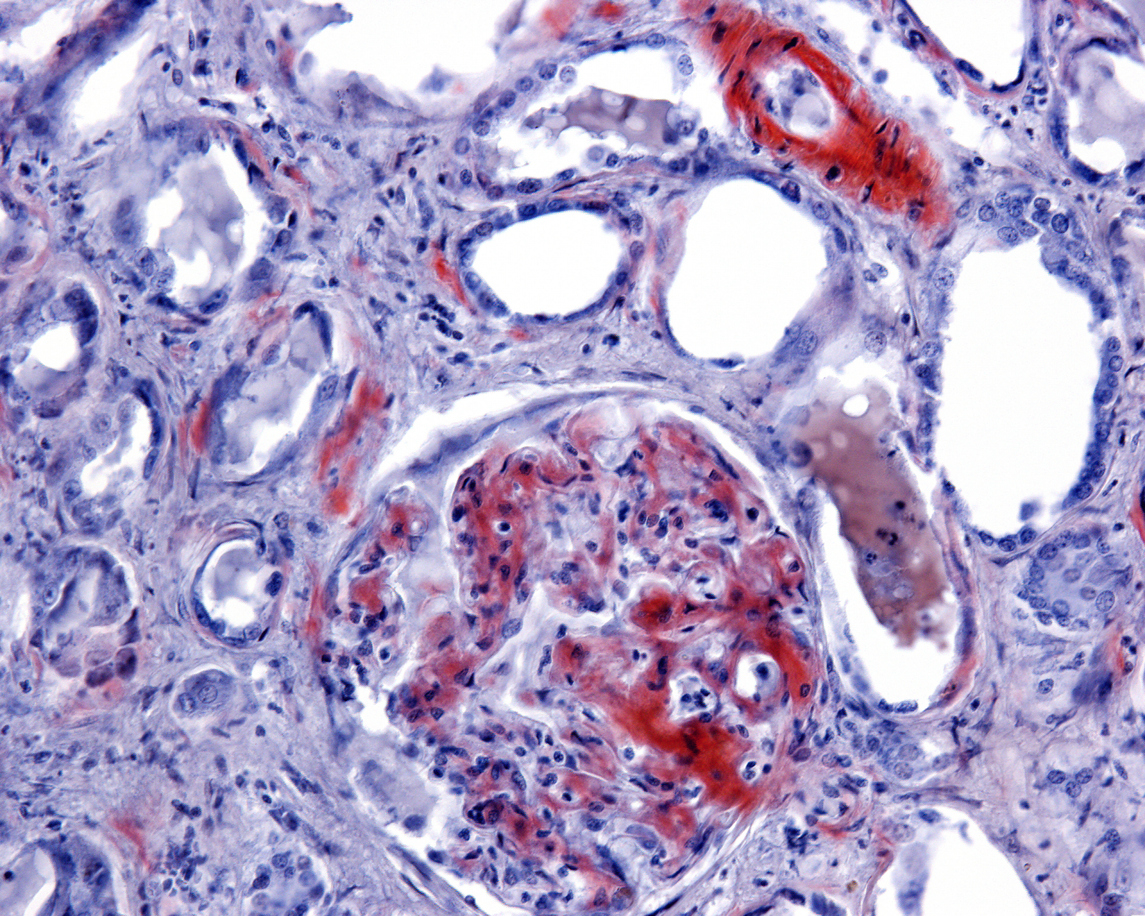 ASH Publishes Clinical Guidelines on AL Amyloidosis Diagnosis - The ...